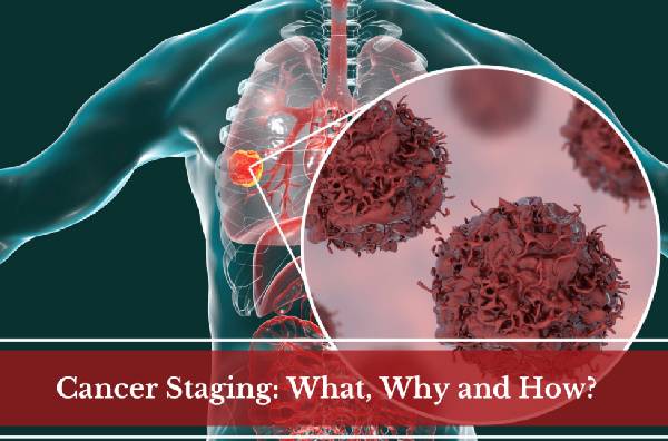 CANCER Diagnosis and Staging: Why Early and Accurate Evaluation Matters ...