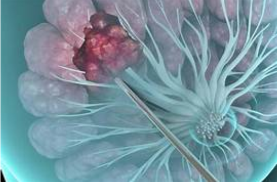 Vacuum-Assisted Breast Biopsy: A Complete Guide to Safe and Accurate ...