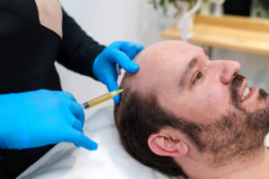 Why Natural Hairline Design Matters More Than Most Hair Transplant ...